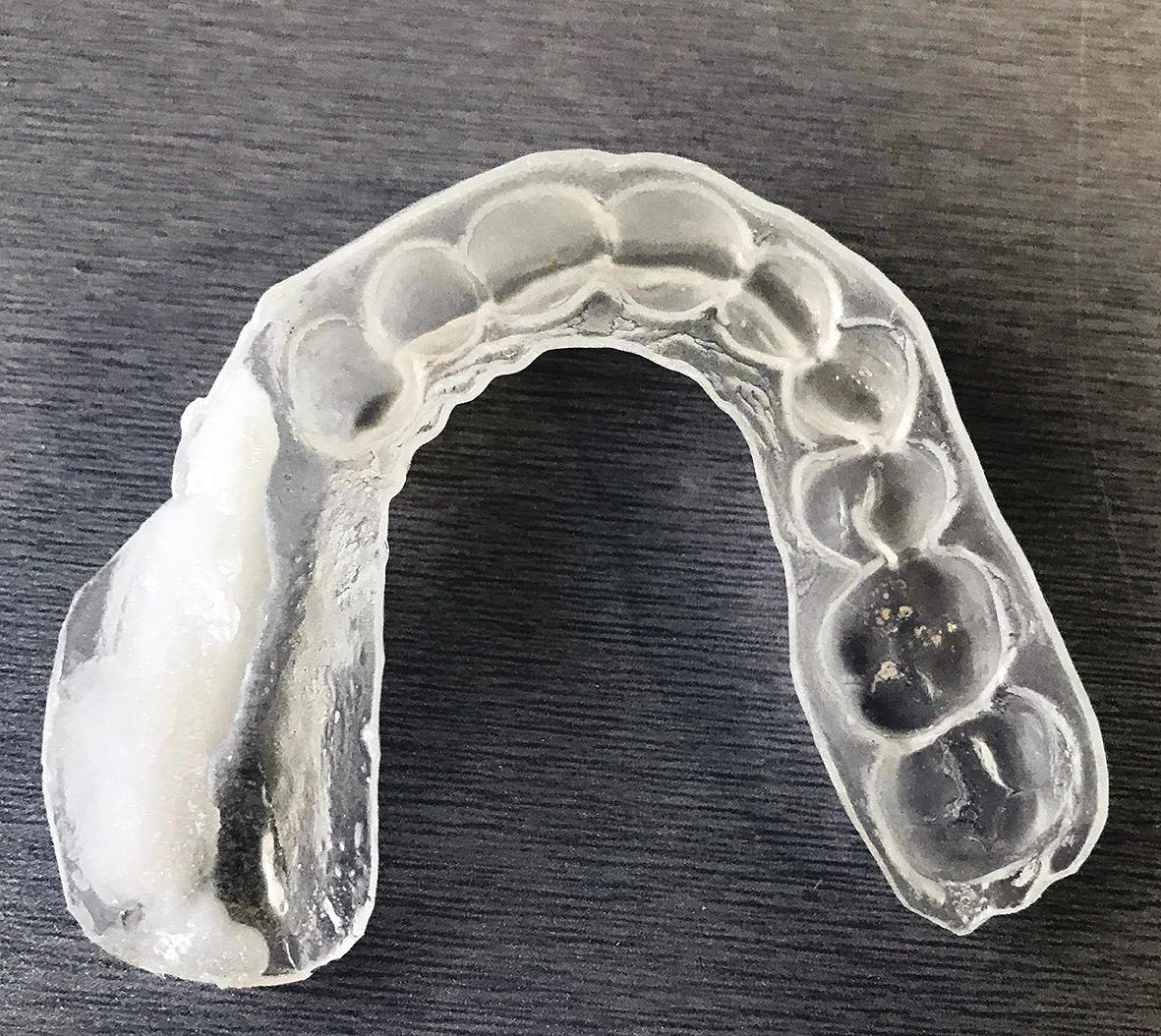 Revista Canal Abierto - Painful post-traumatic trigeminal neuropathy ...