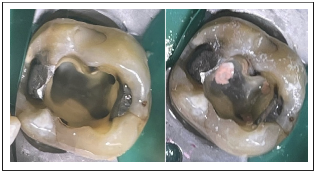 Revista Canal Abierto - Endodontic Treatment As An Alternative In ...